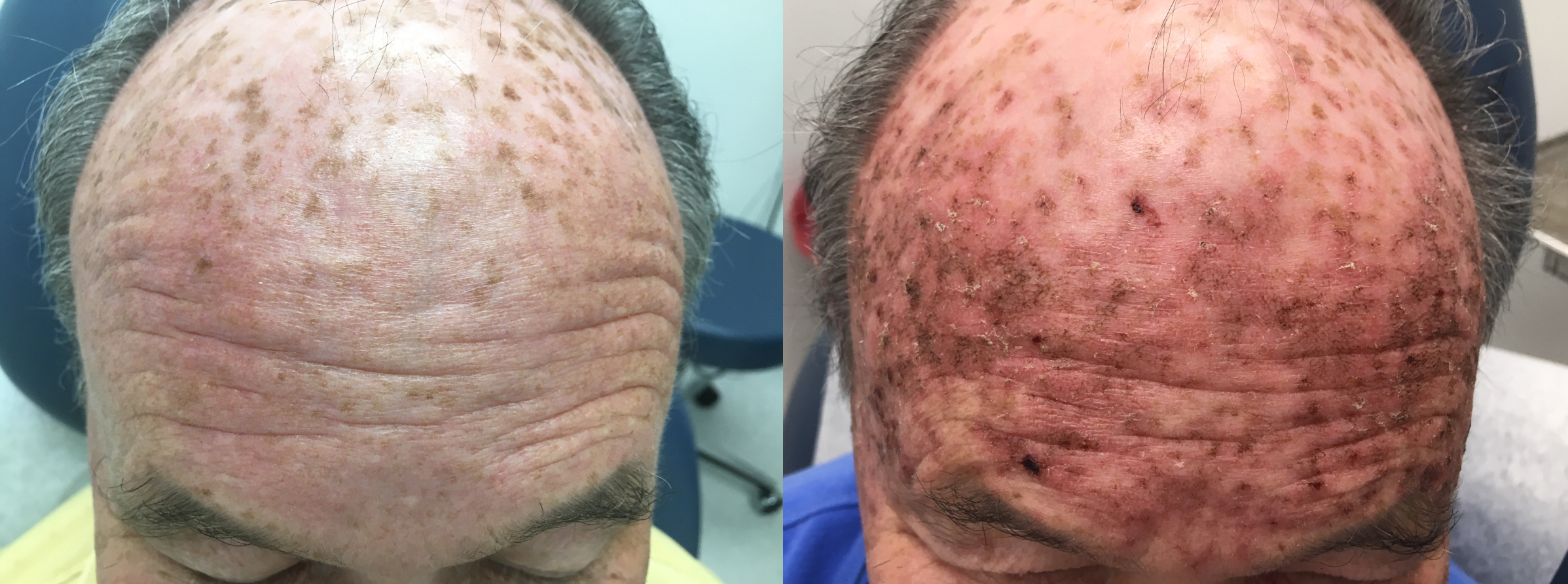 Before And After Photos Dermassociates